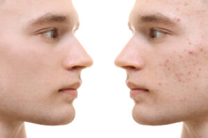 Acné rosacée - Symptômes - traitement - diagnostic - causes - Le-quArtier